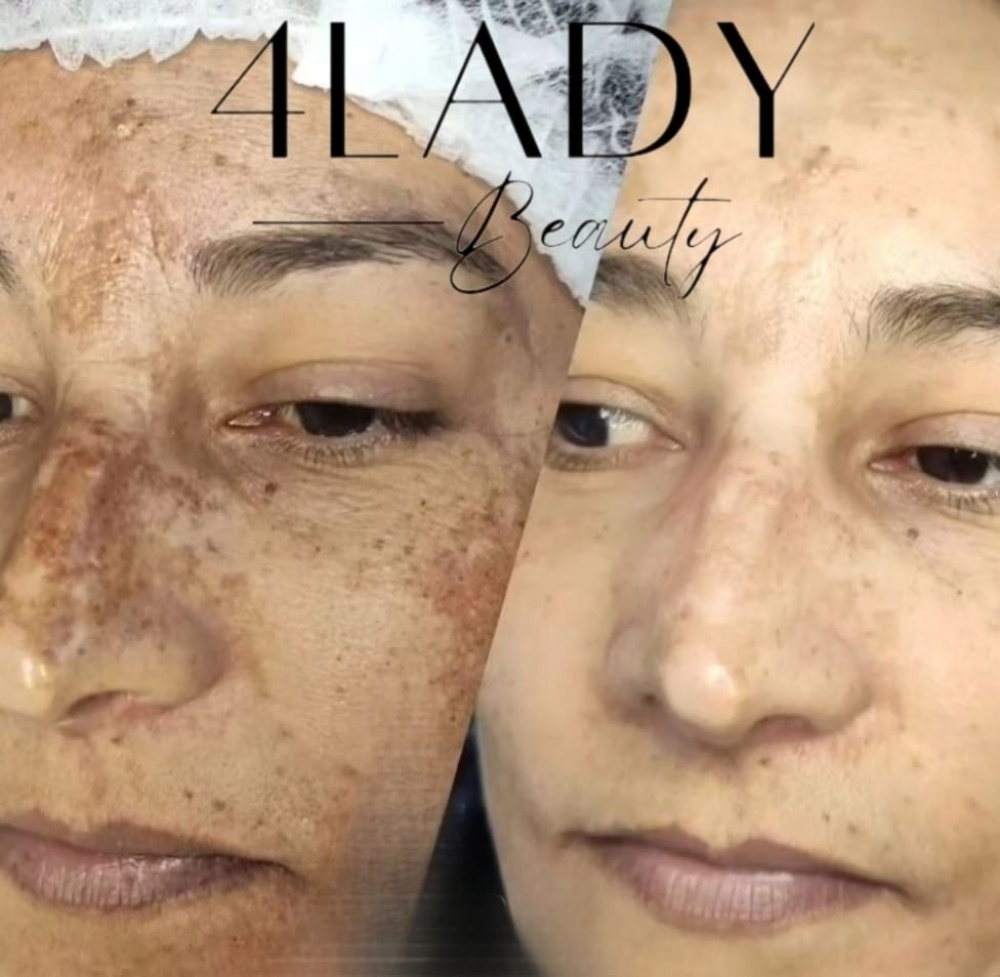 MELASMA 4LADY KIT removedor de manchas - 4lady_beauty